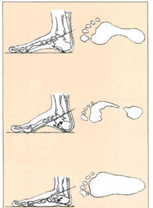 Kun jalkaan sattuu. - Preston