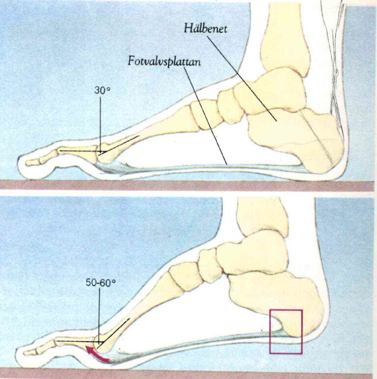 Kun jalkaan sattuu. - Preston